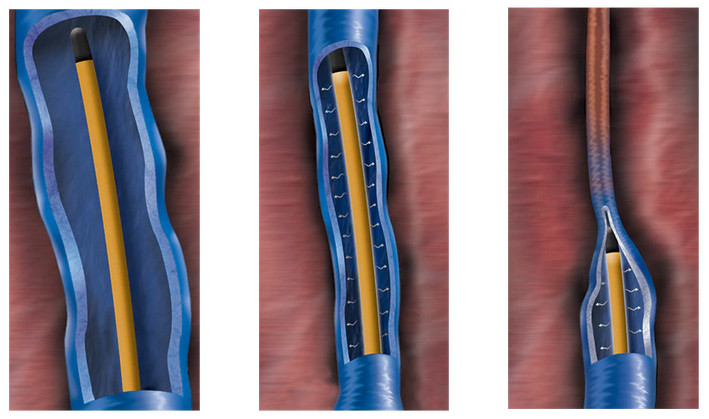 Radiofrequency Ablation for Chronic Venous Insufficiency (CVI ...