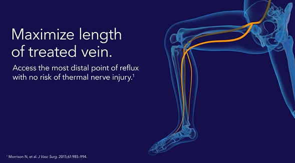 VenaSeal™ Closure System - Incredible Veins